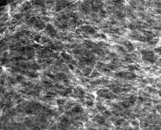 Pathology Outlines - Microcalcifications