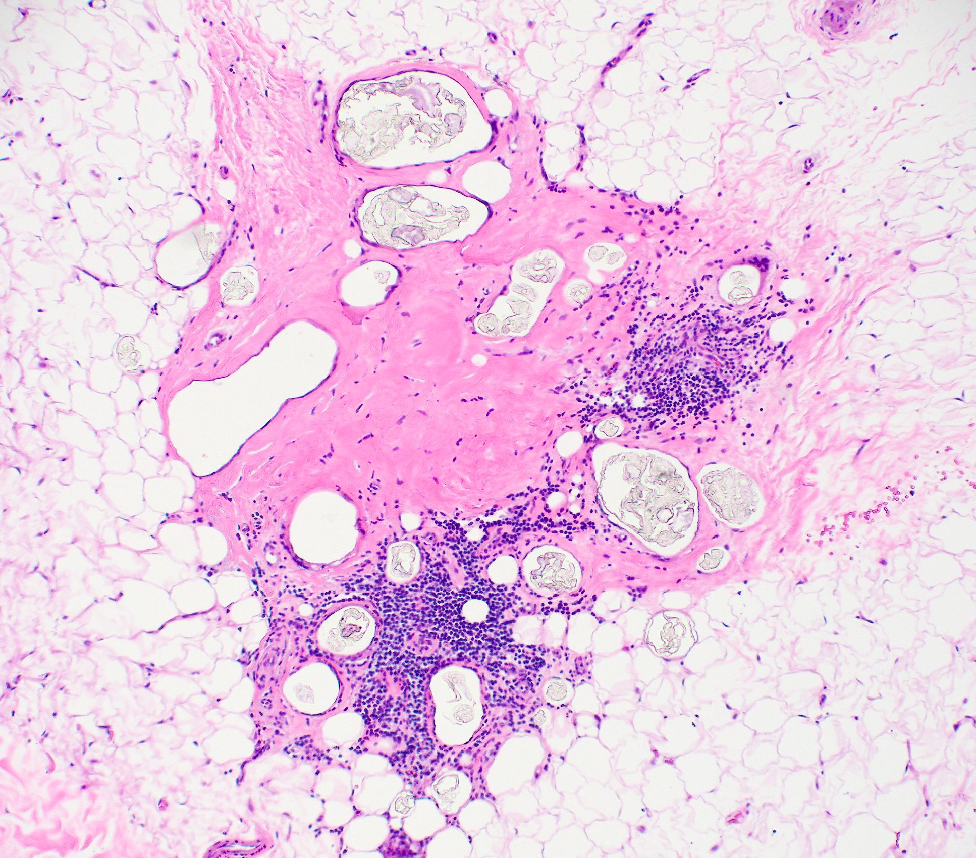 Pathology Outlines - Foreign body reaction