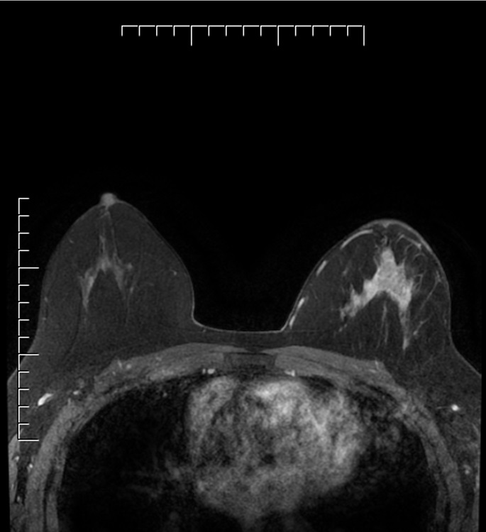 Pathology Outlines - Acinic cell carcinoma