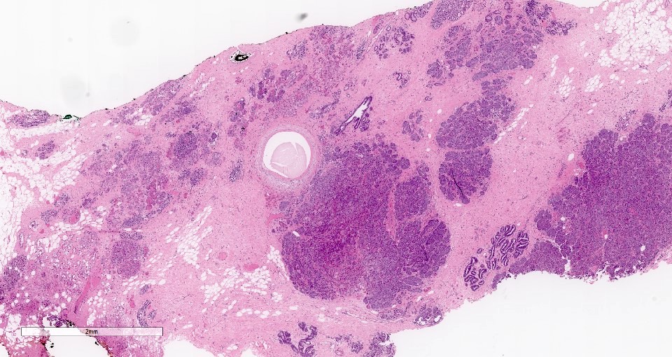 Pathology Outlines - Acinic cell carcinoma