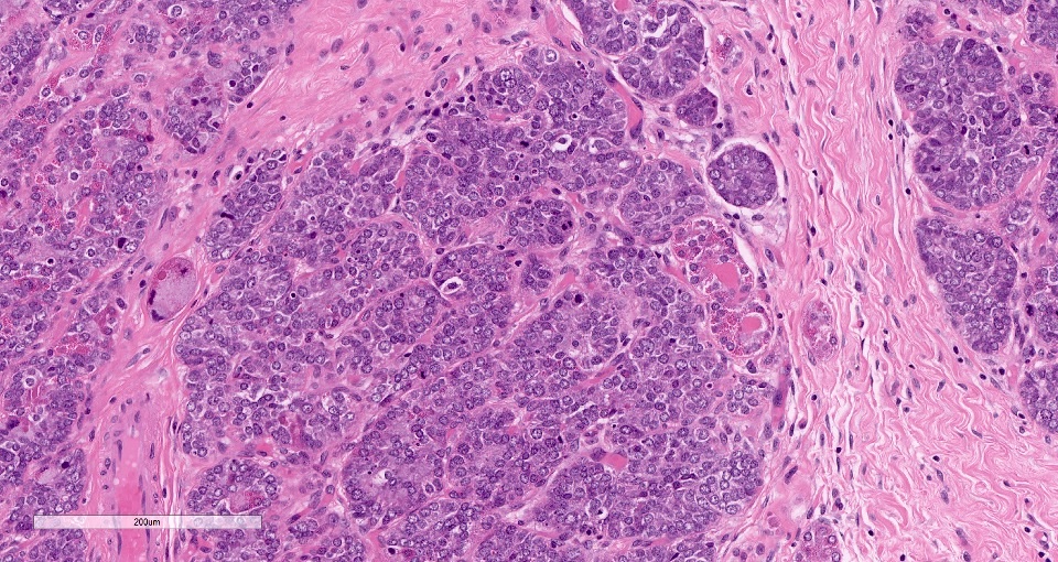 Pathology Outlines - Acinic cell carcinoma