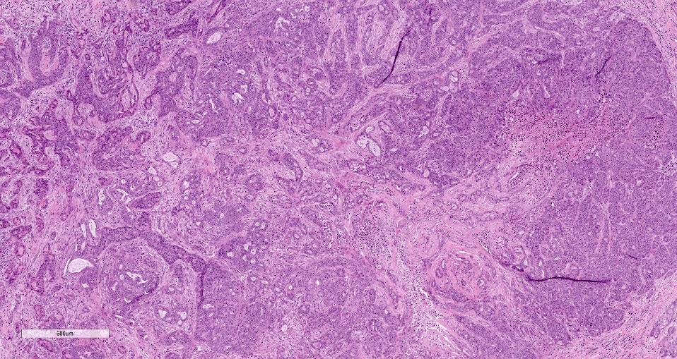 Pathology Outlines - Acinic cell carcinoma