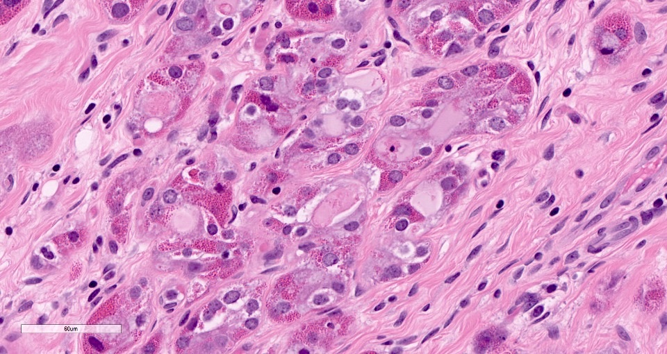 Pathology Outlines - Acinic cell carcinoma
