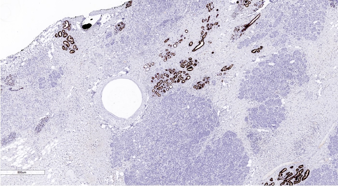 Pathology Outlines - Acinic cell carcinoma