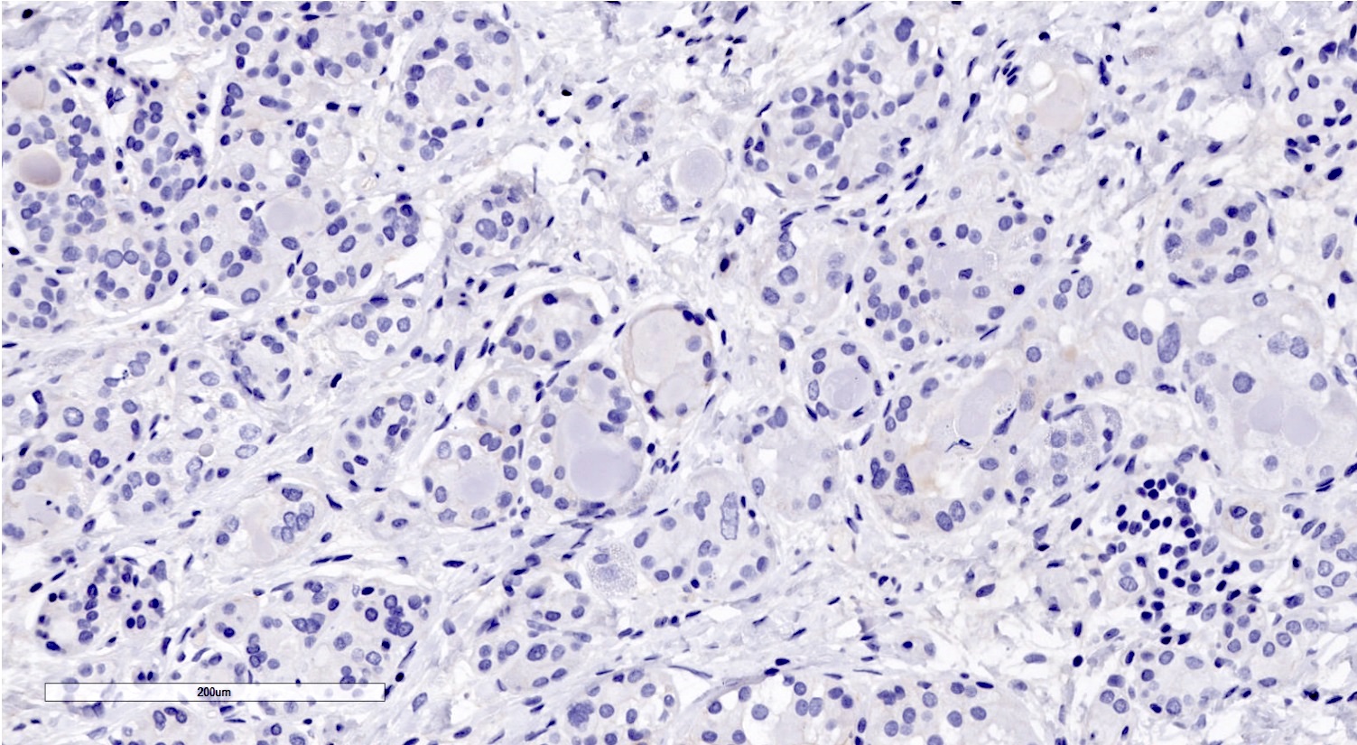 Pathology Outlines - Acinic cell carcinoma