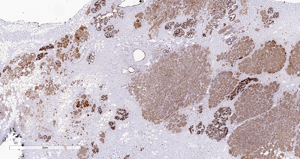 Pathology Outlines - Acinic cell carcinoma