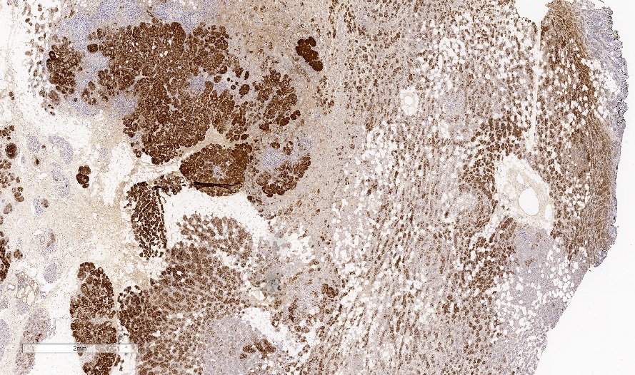 Pathology Outlines - Acinic cell carcinoma