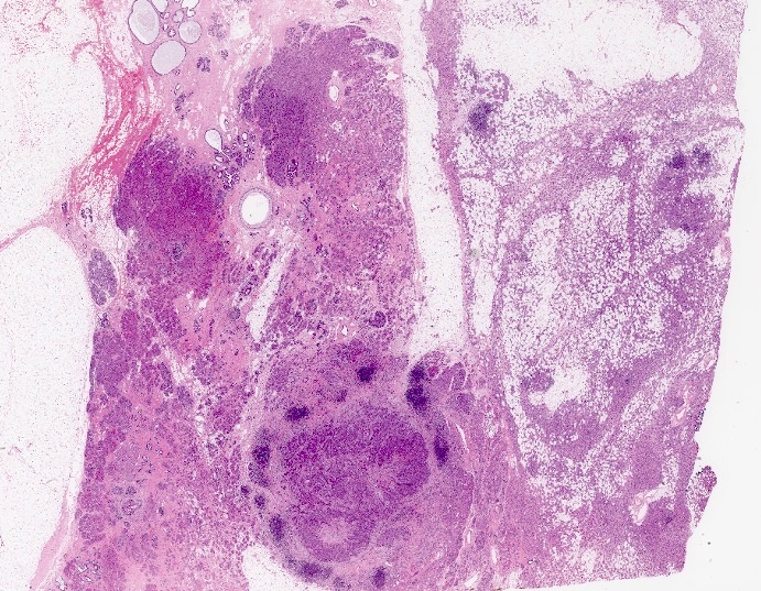 Pathology Outlines - Acinic cell carcinoma