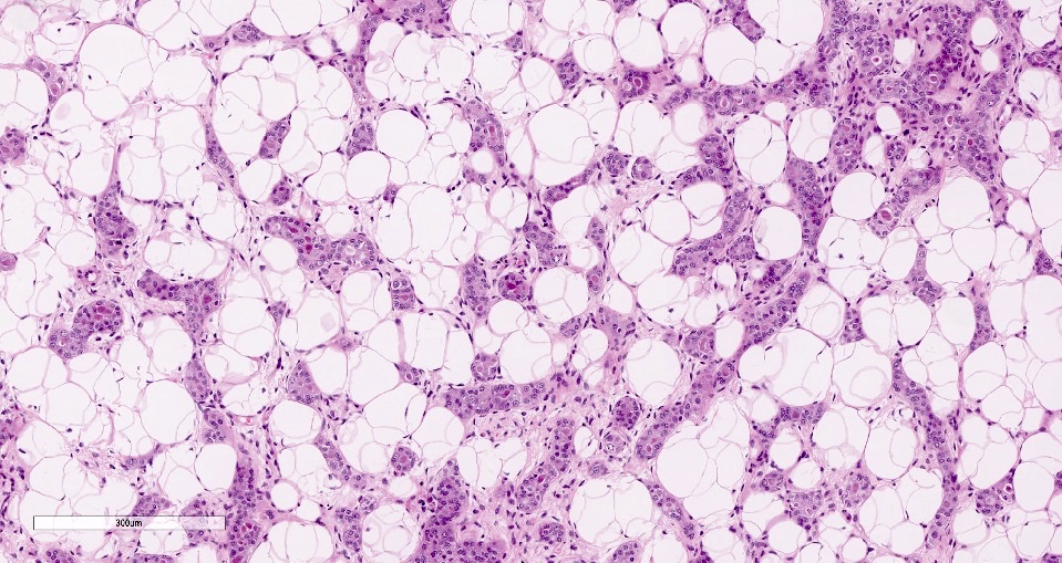Pathology Outlines - Acinic cell carcinoma