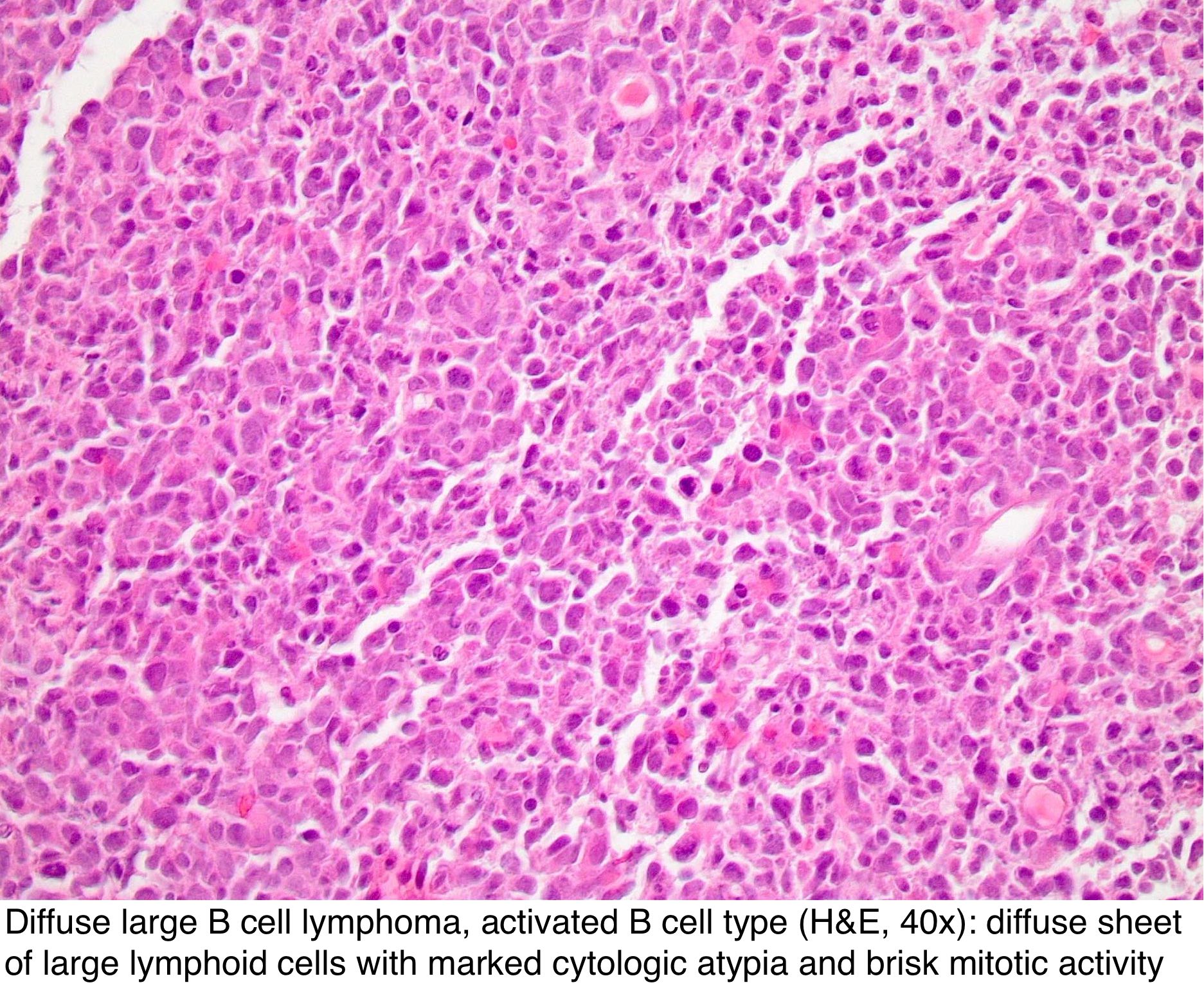 Pathology Outlines - Lymphoma