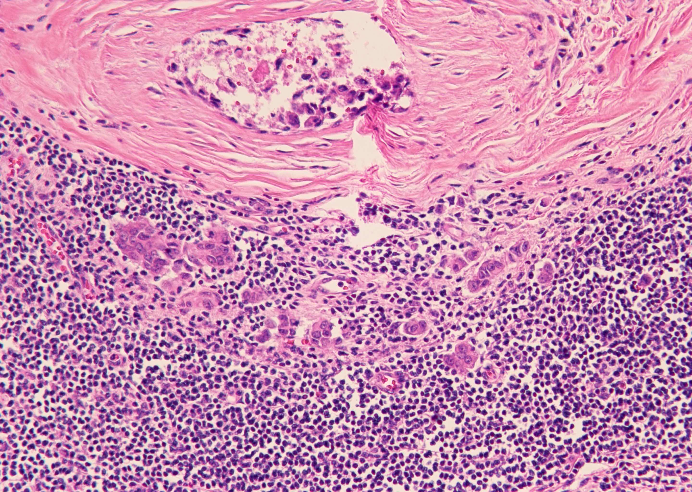 Pathology Outlines - Microinvasive
