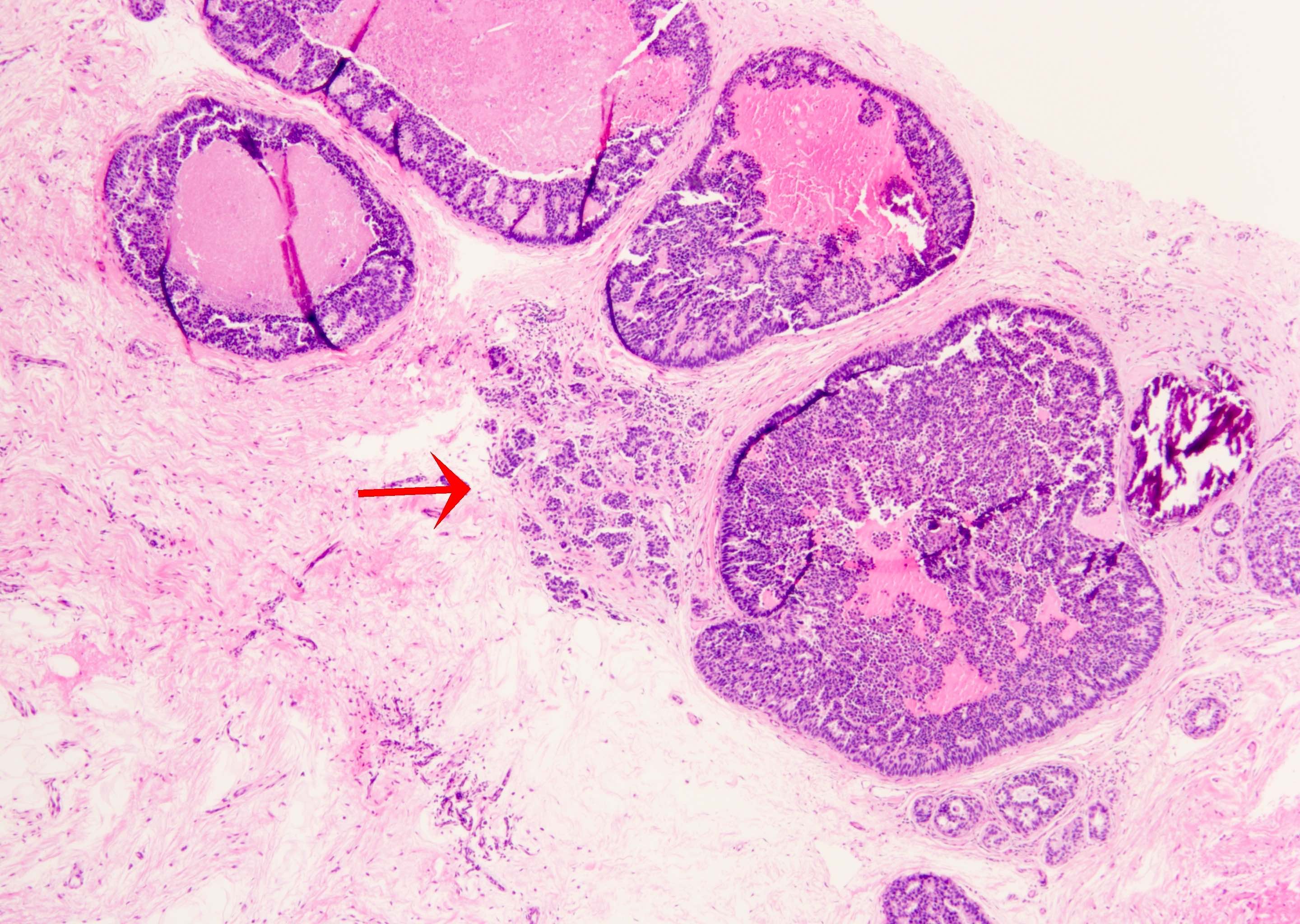 Pathology Outlines - Microinvasive
