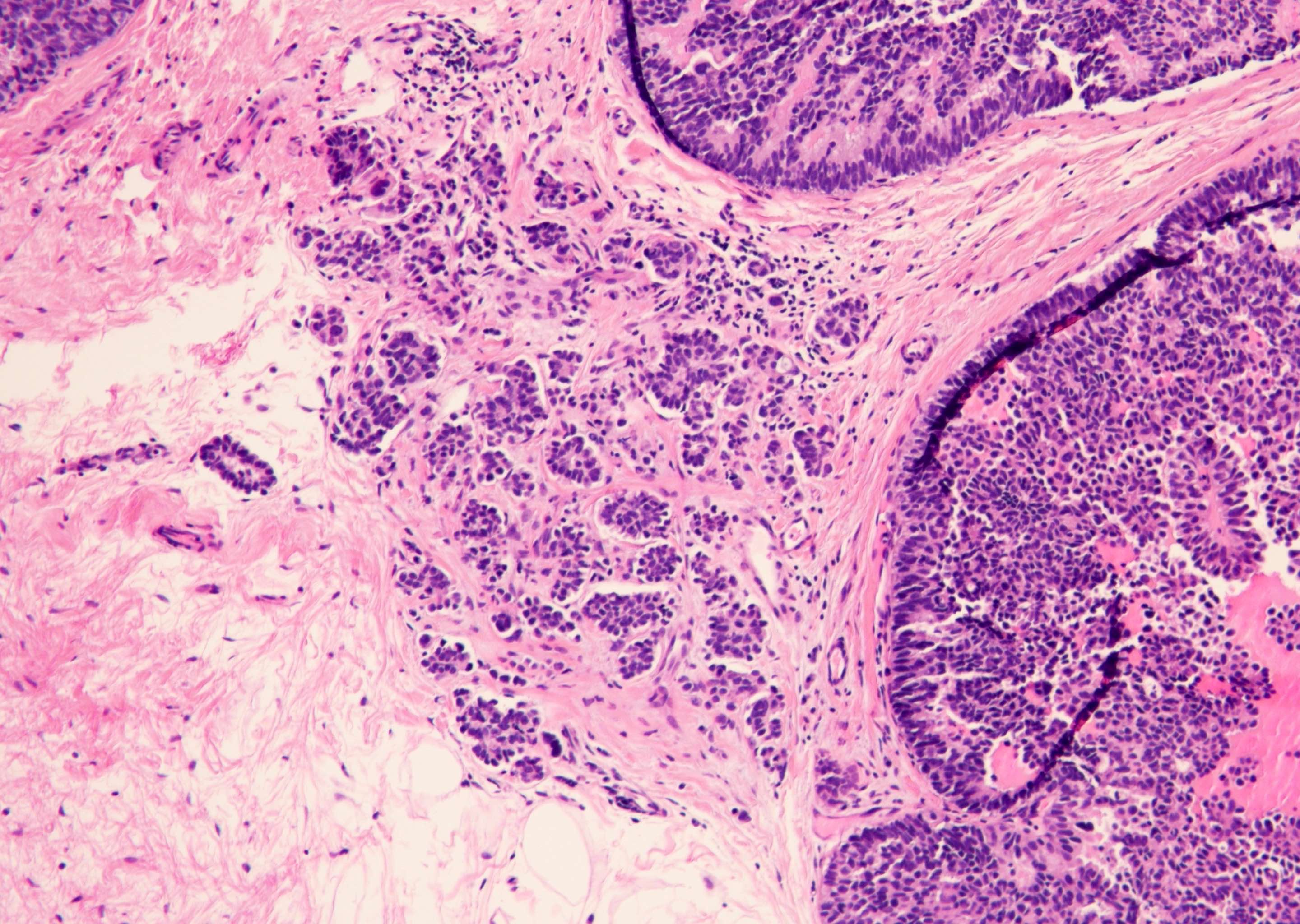 Pathology Outlines - Microinvasive