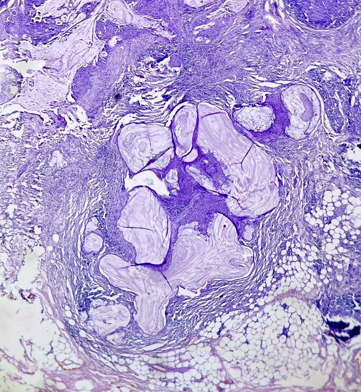 Pathology Outlines - Mucoepidermoid