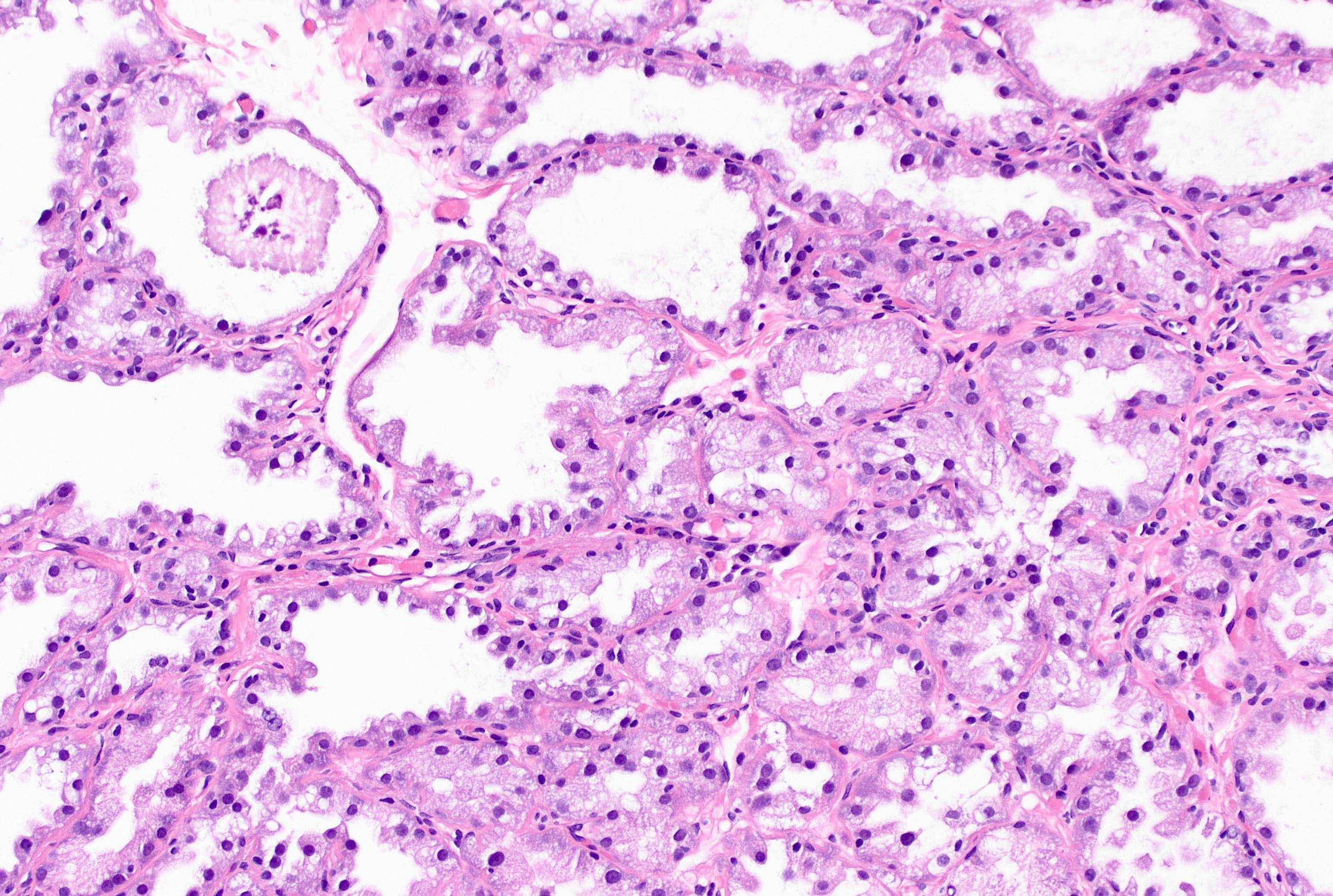 Pathology Outlines - Secretory change