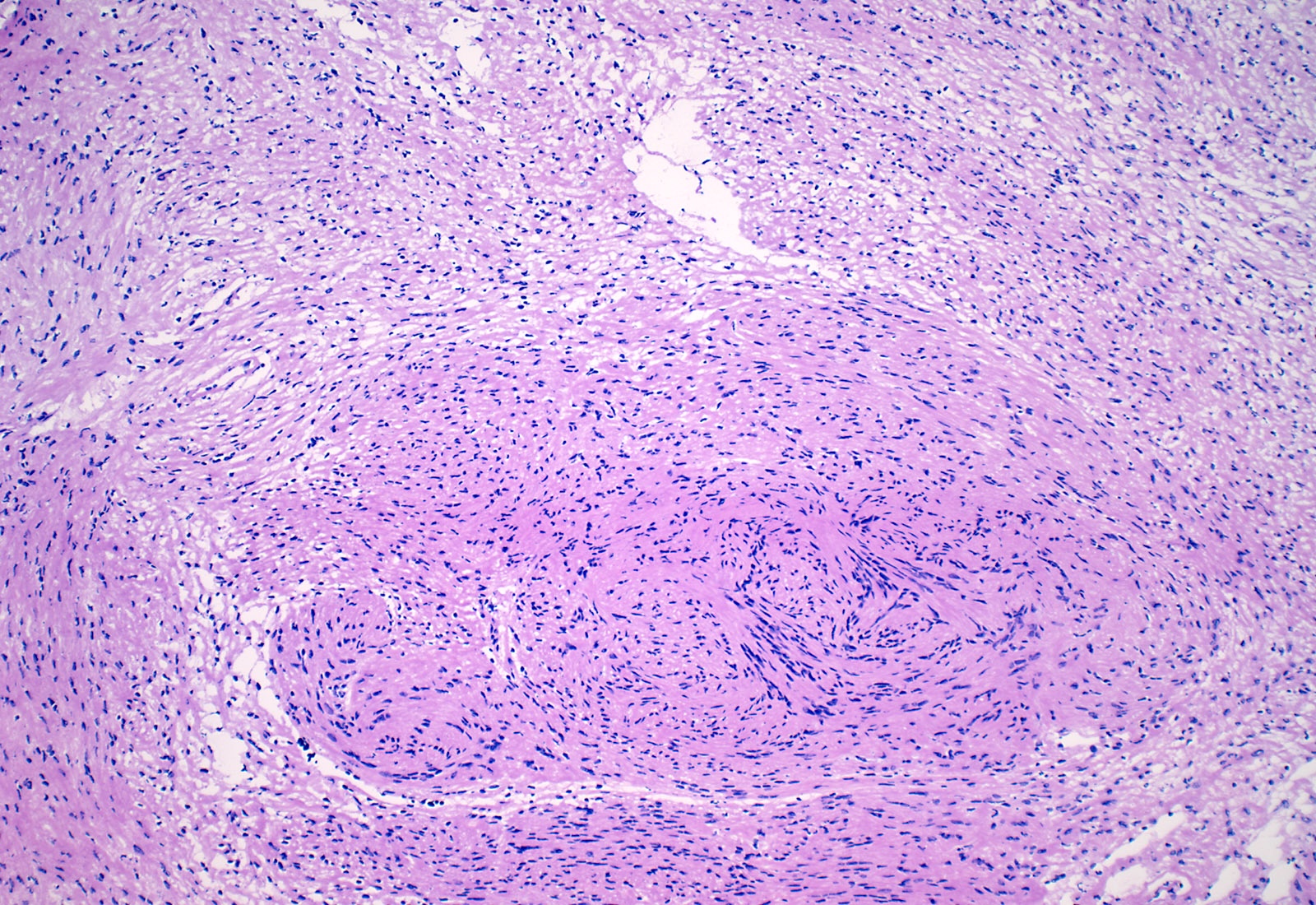 Pathology Outlines - Schwannoma