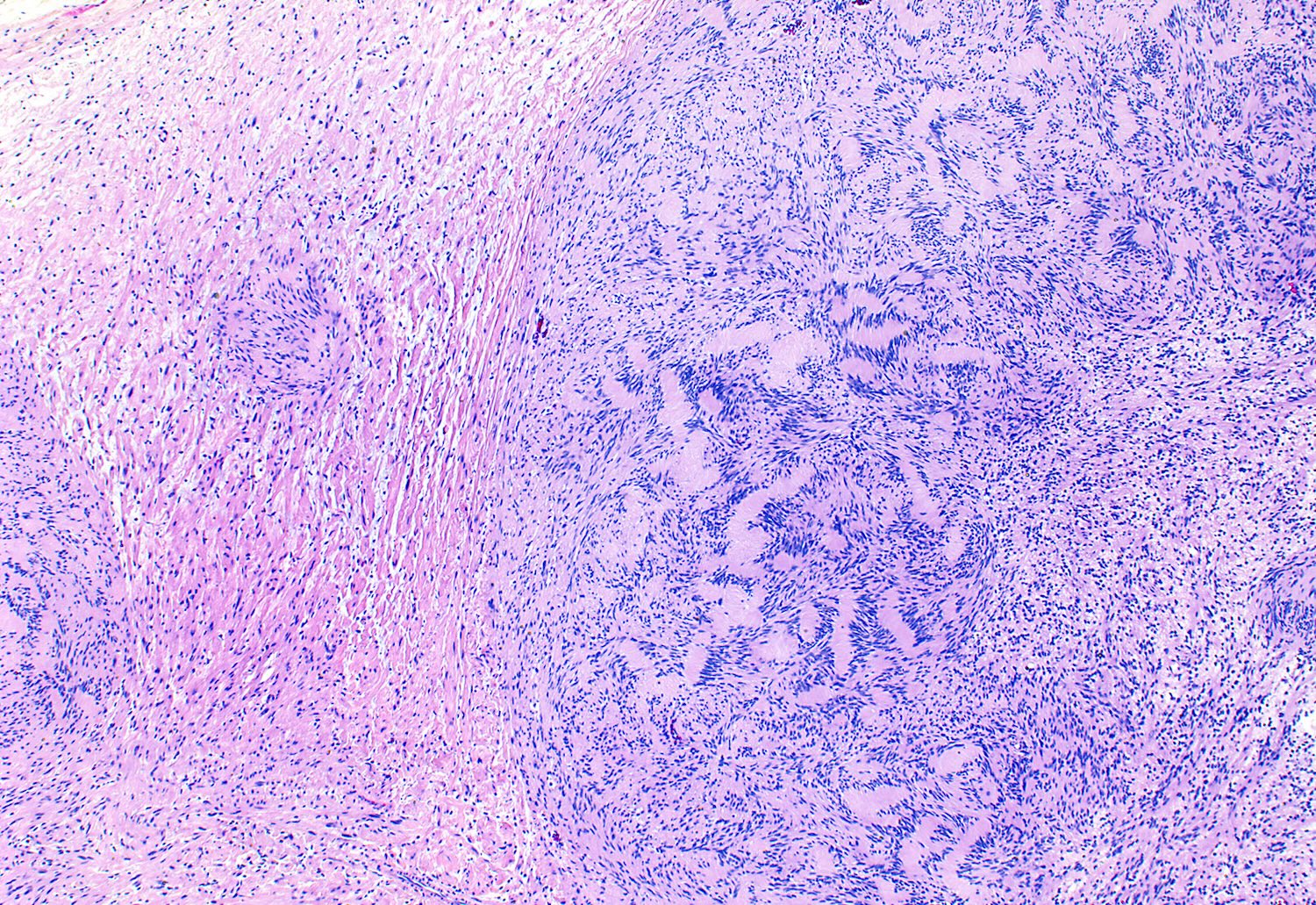 Pathology Outlines - Schwannoma