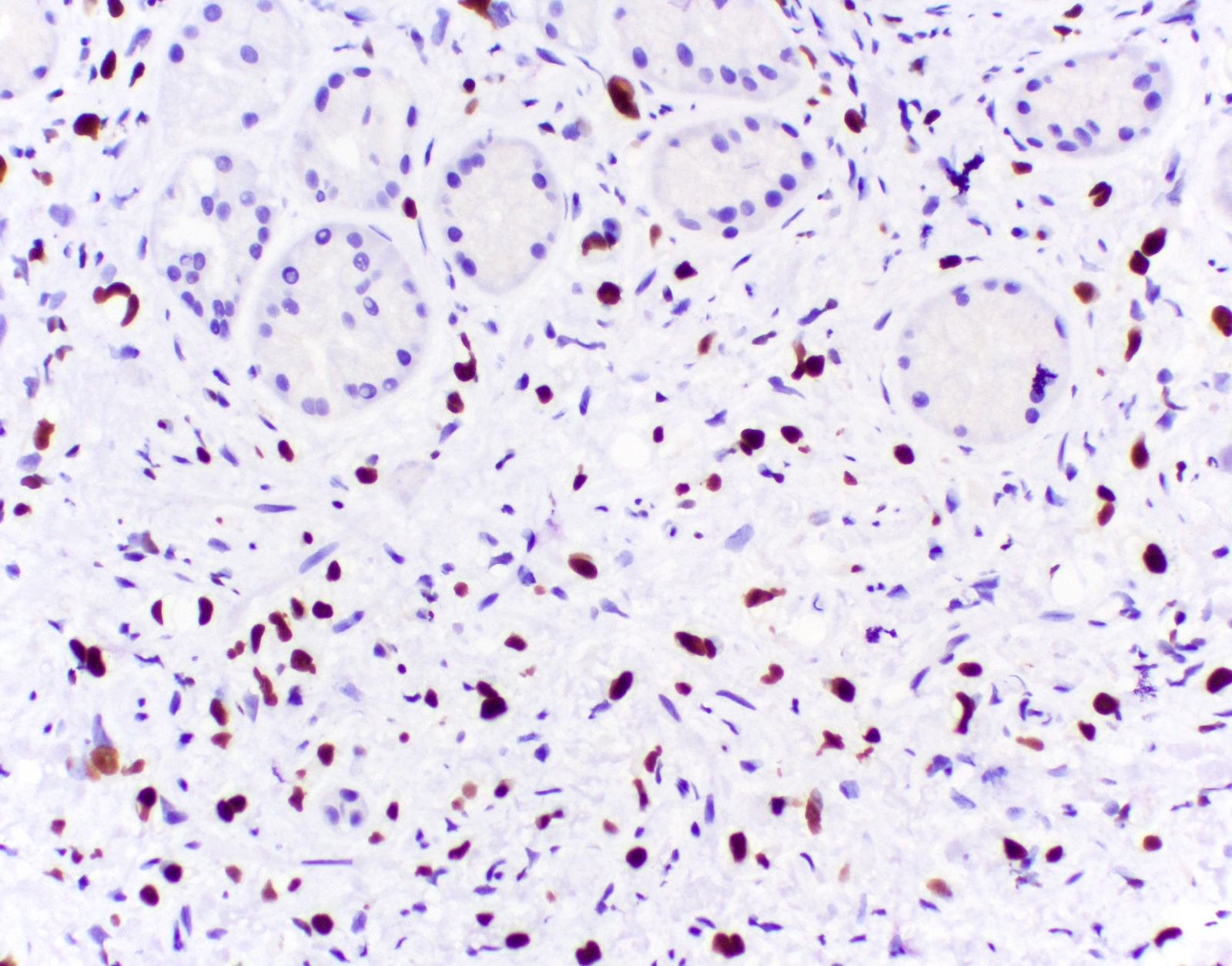 Pathology Outlines - Signet ring cell