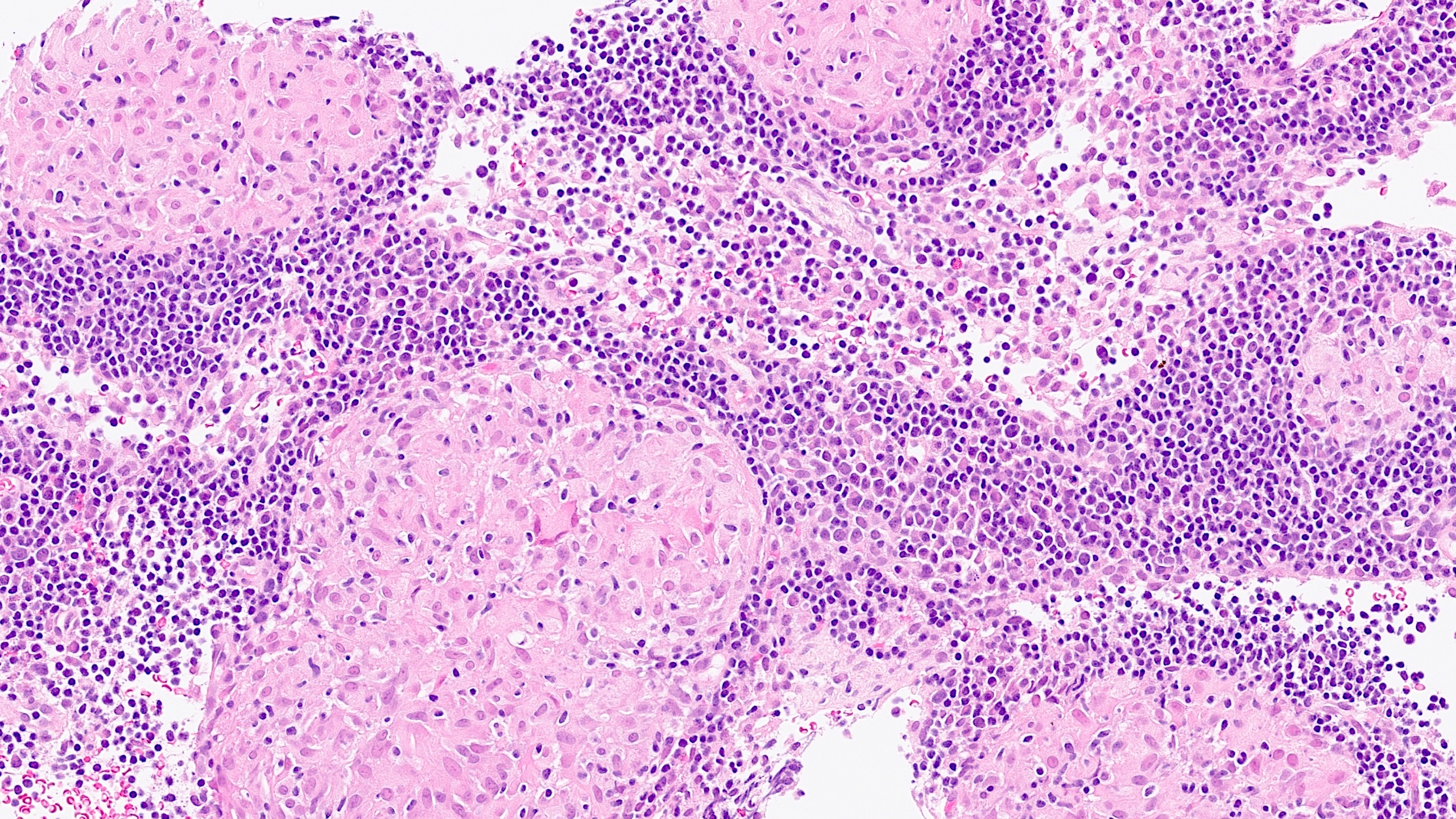 Pathology Outlines - Tuberculosis