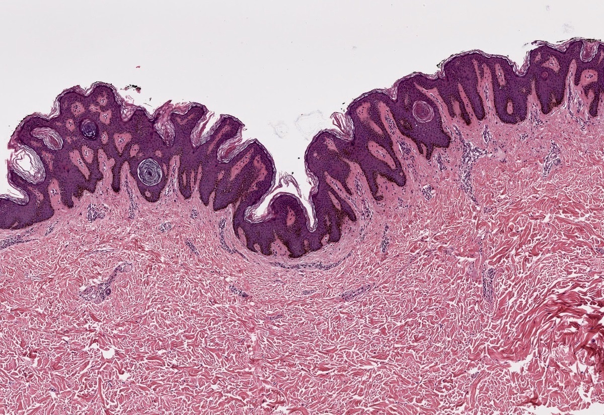 Pathology Outlines - Epidermal nevus