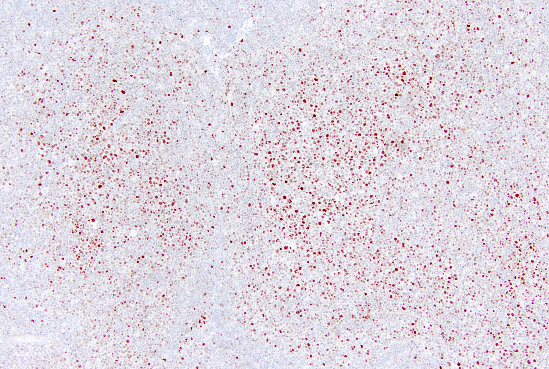 Pathology Outlines - CD5