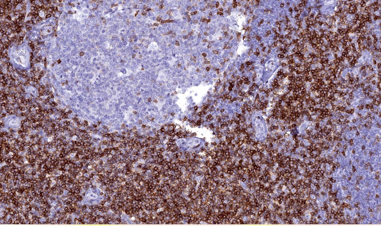 Pathology Outlines - CD5
