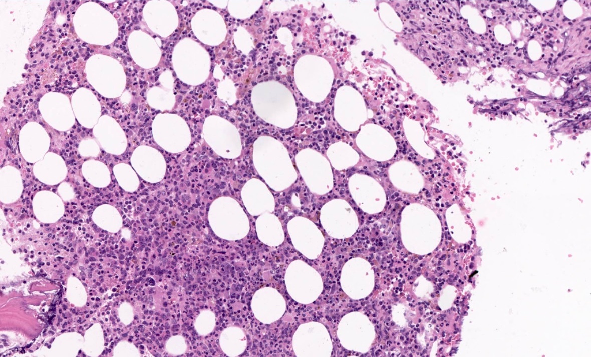 Pathology Outlines - CD61
