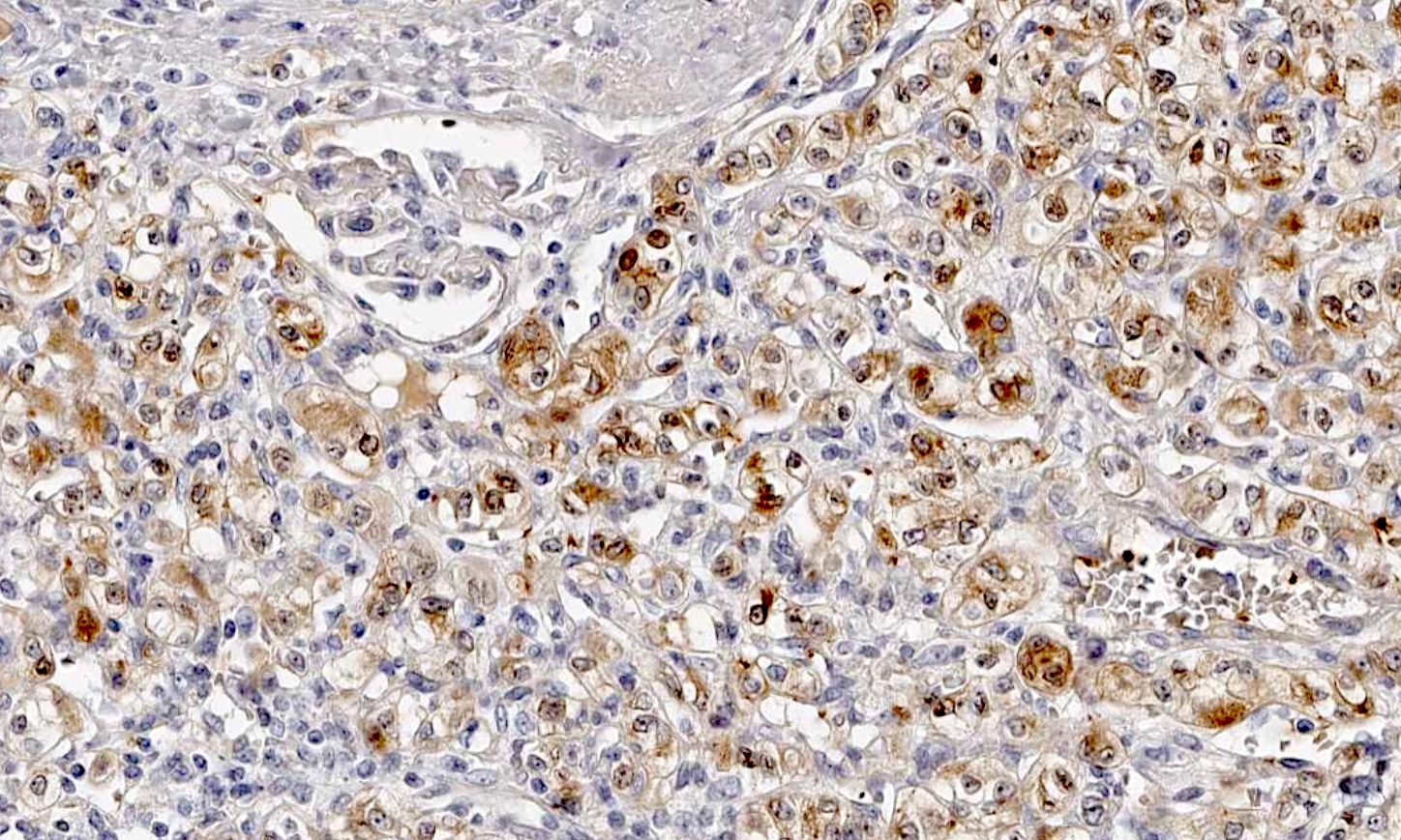 Pathology Outlines - CD61