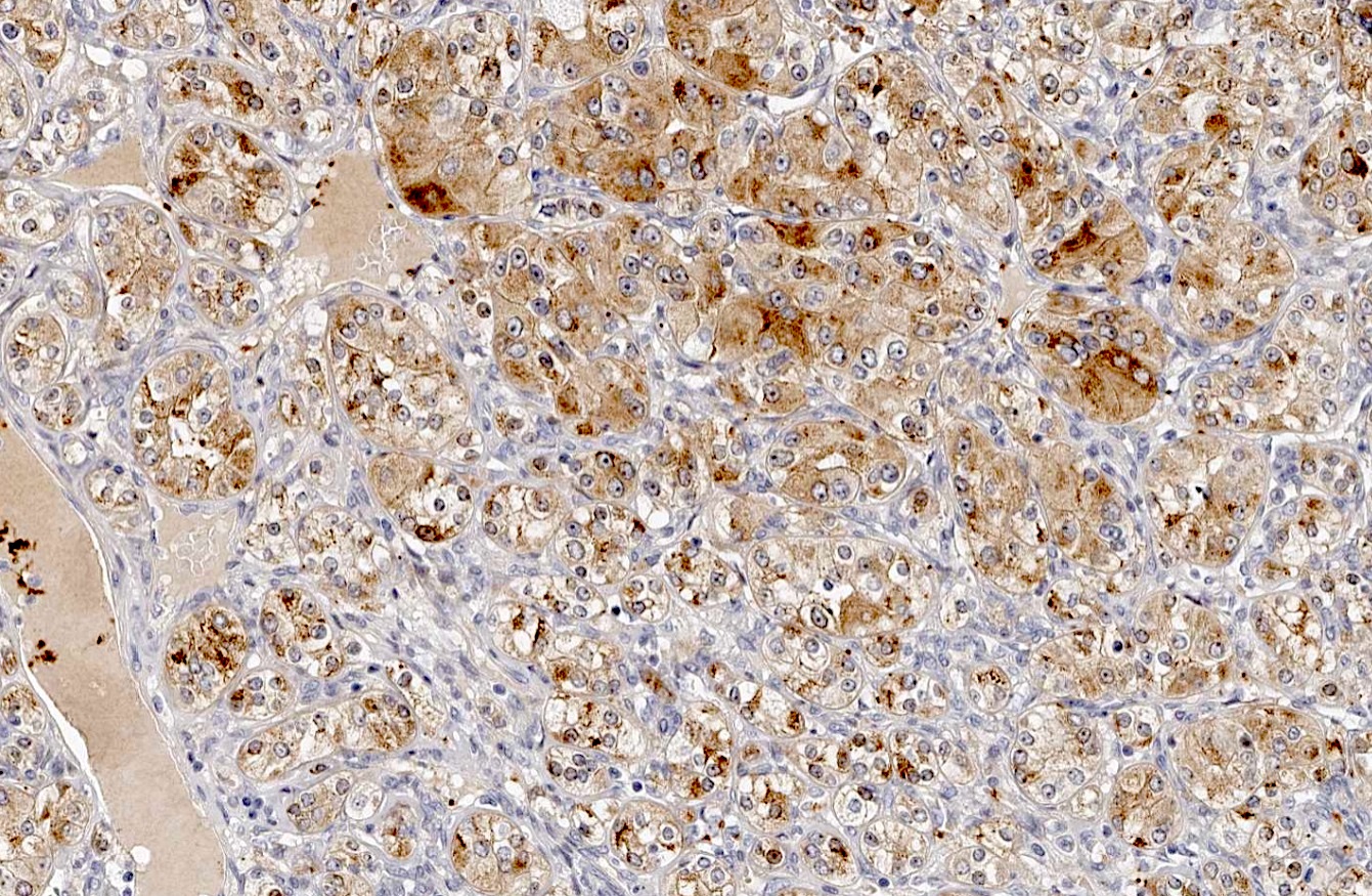 Pathology Outlines - CD61