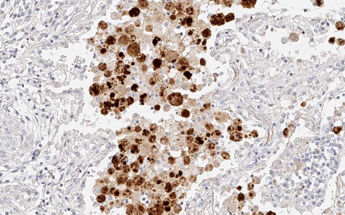 Pathology Outlines - CD61