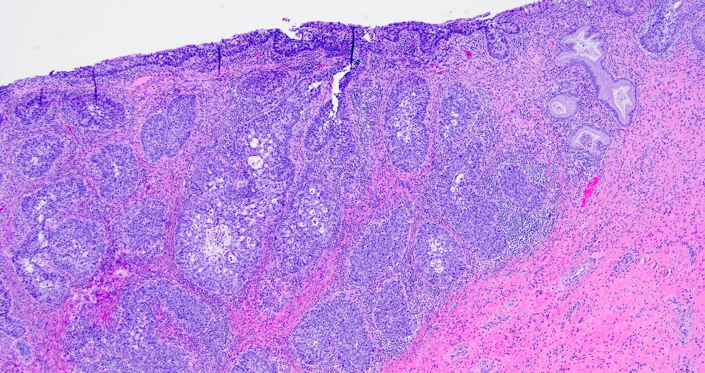 Pathology Outlines - SMILE (stratified mucin producing intraepithelial ...