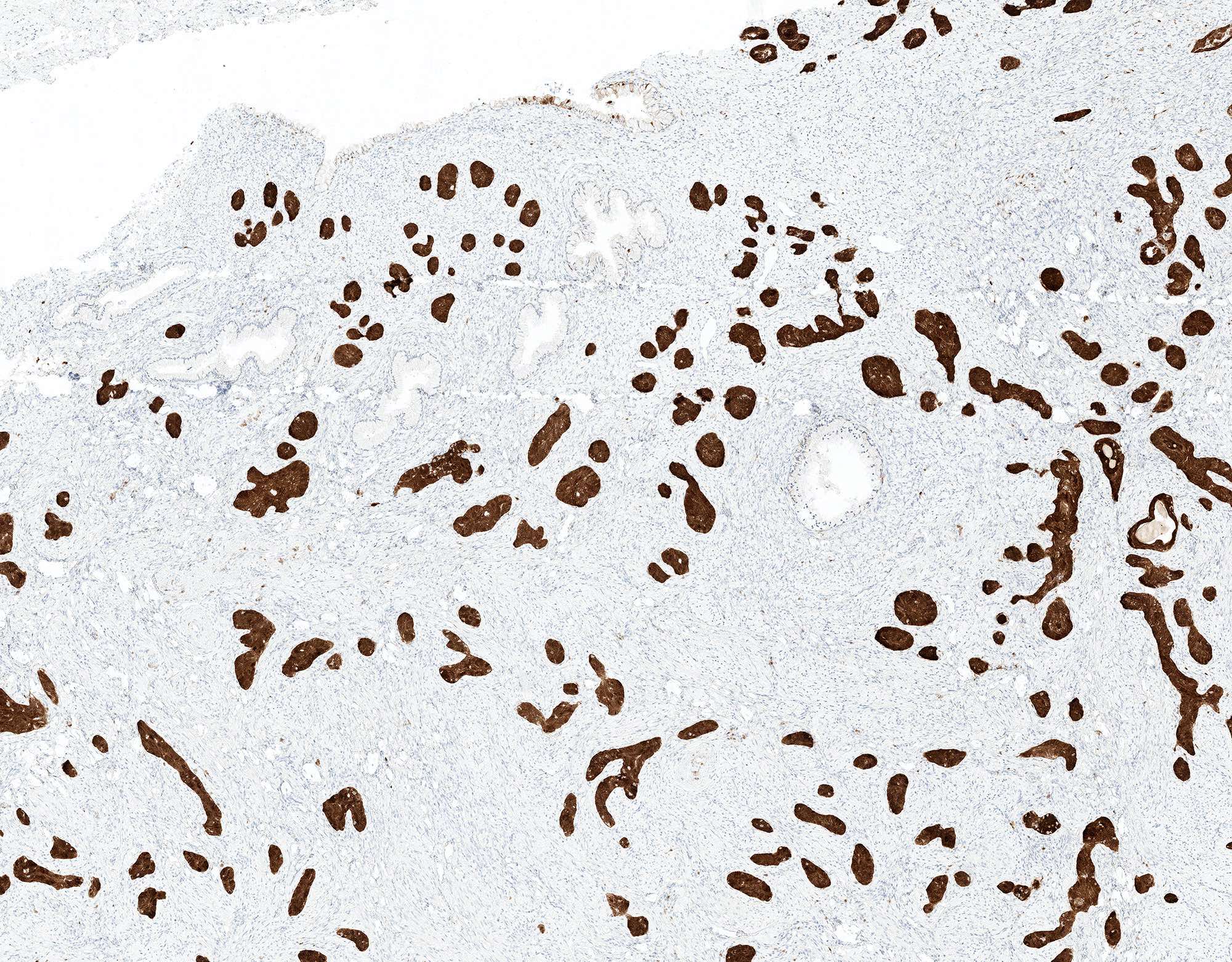 Pathology Outlines - Adenoid basal carcinoma