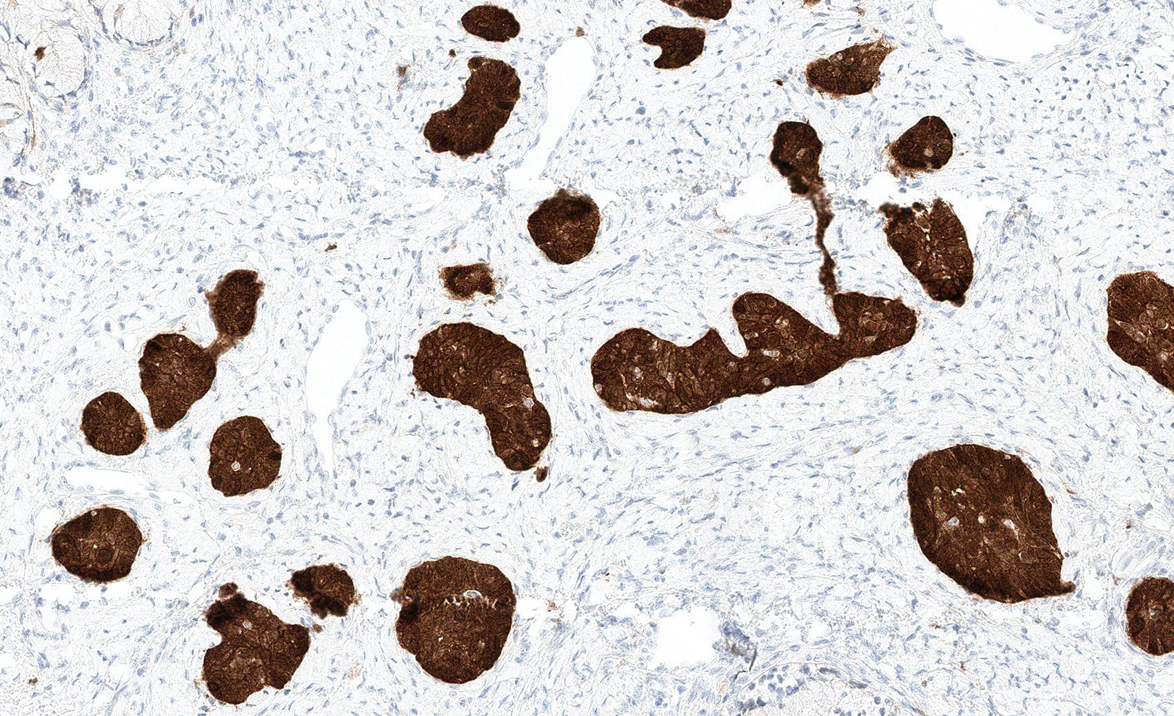 Pathology Outlines - Adenoid basal carcinoma
