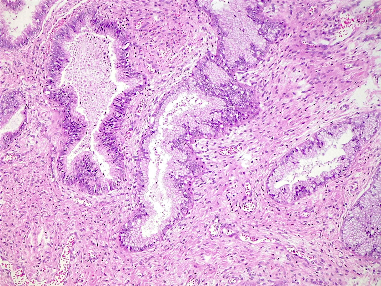Pathology Outlines Histology Pathology Outlines Chordoma
