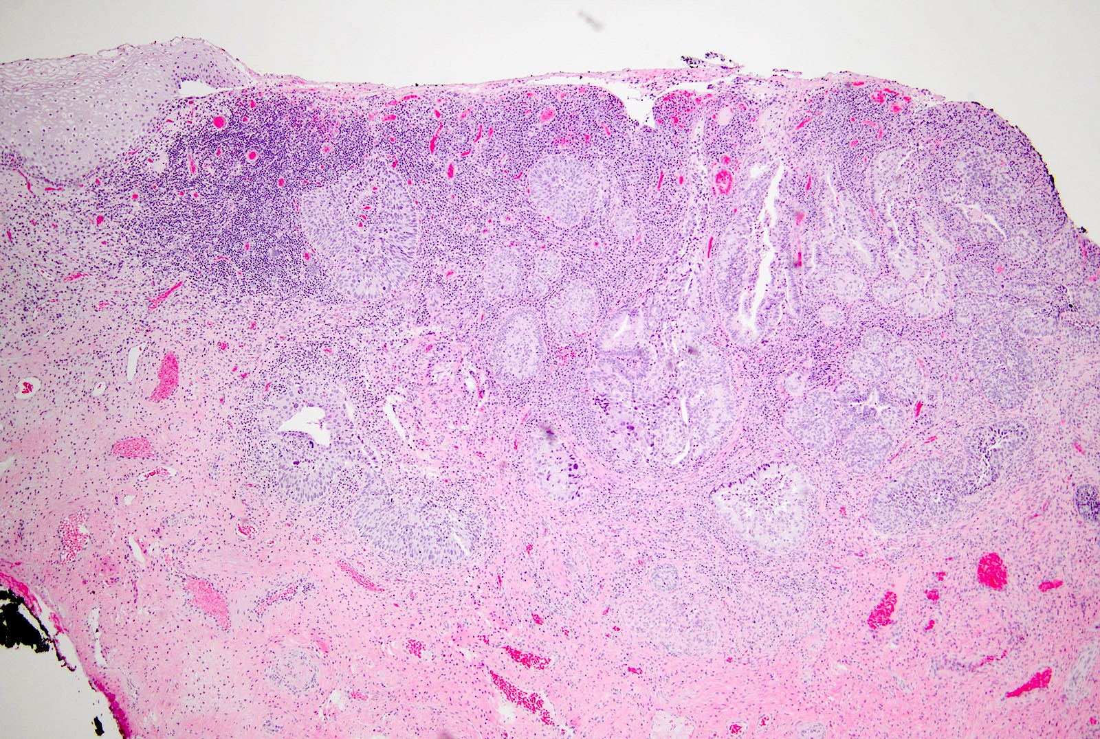 Pathology Outlines - Invasive stratified mucin producing carcinoma