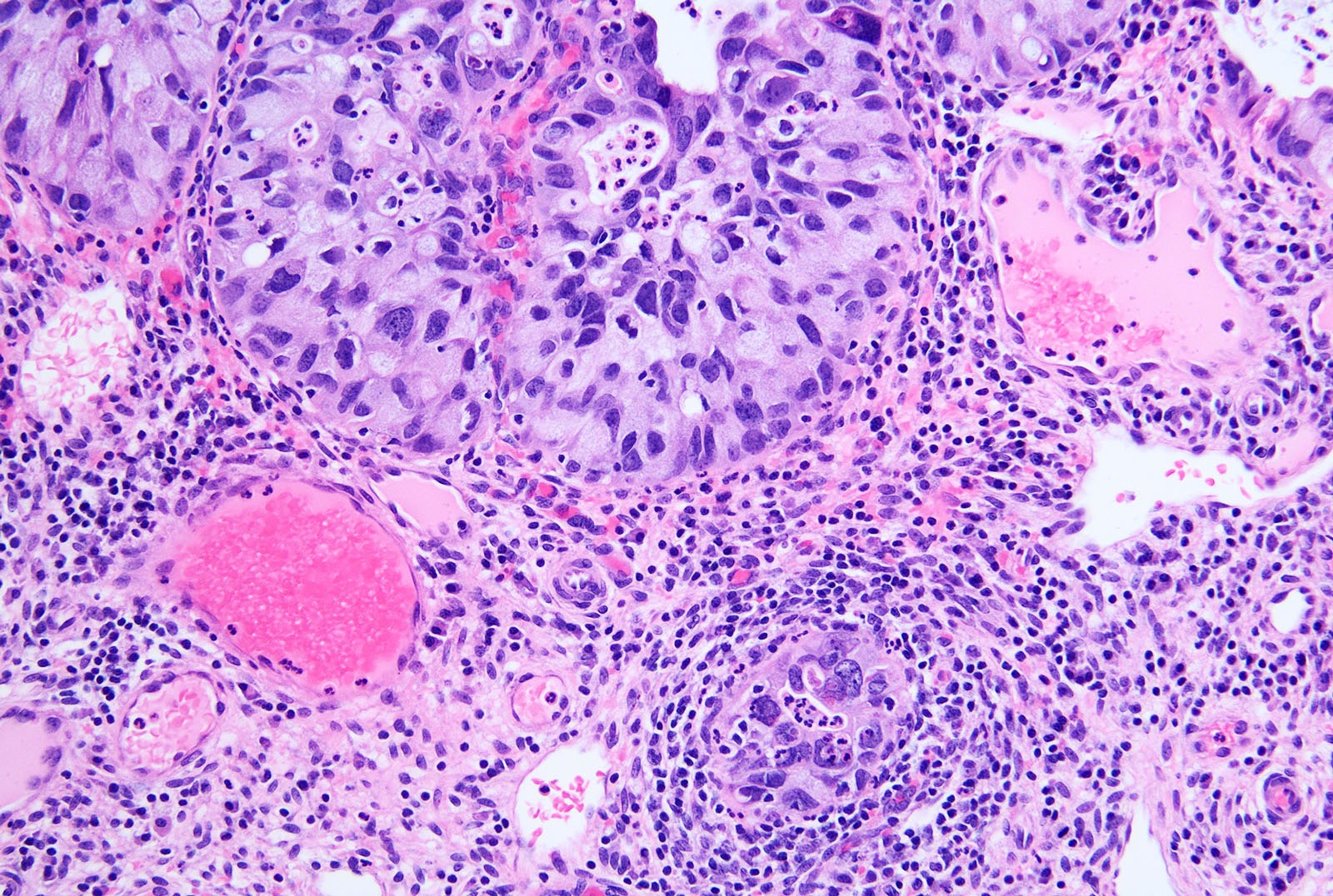 Pathology Outlines - Invasive stratified mucin producing carcinoma
