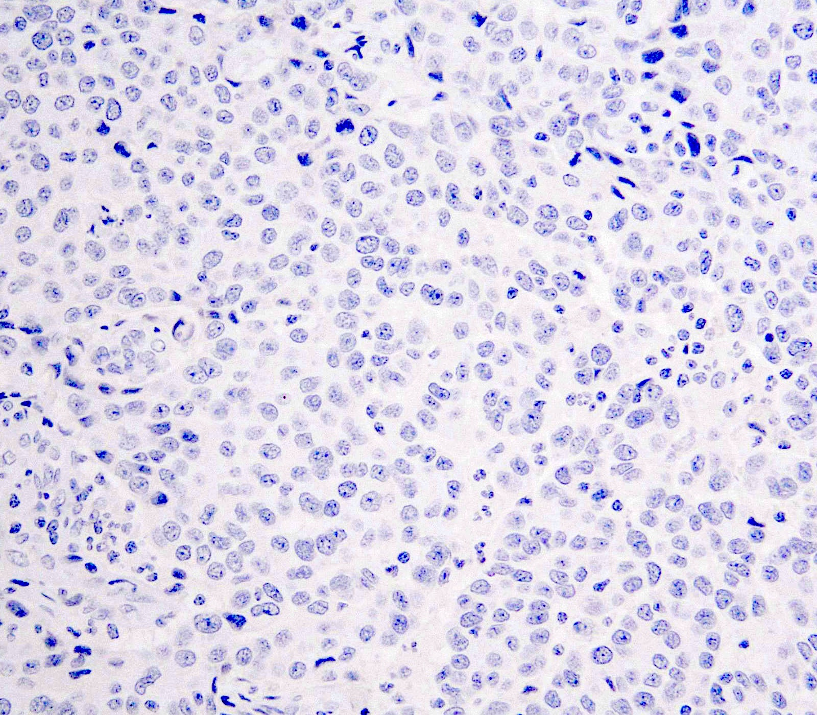 Pathology Outlines - Invasive stratified mucin producing carcinoma