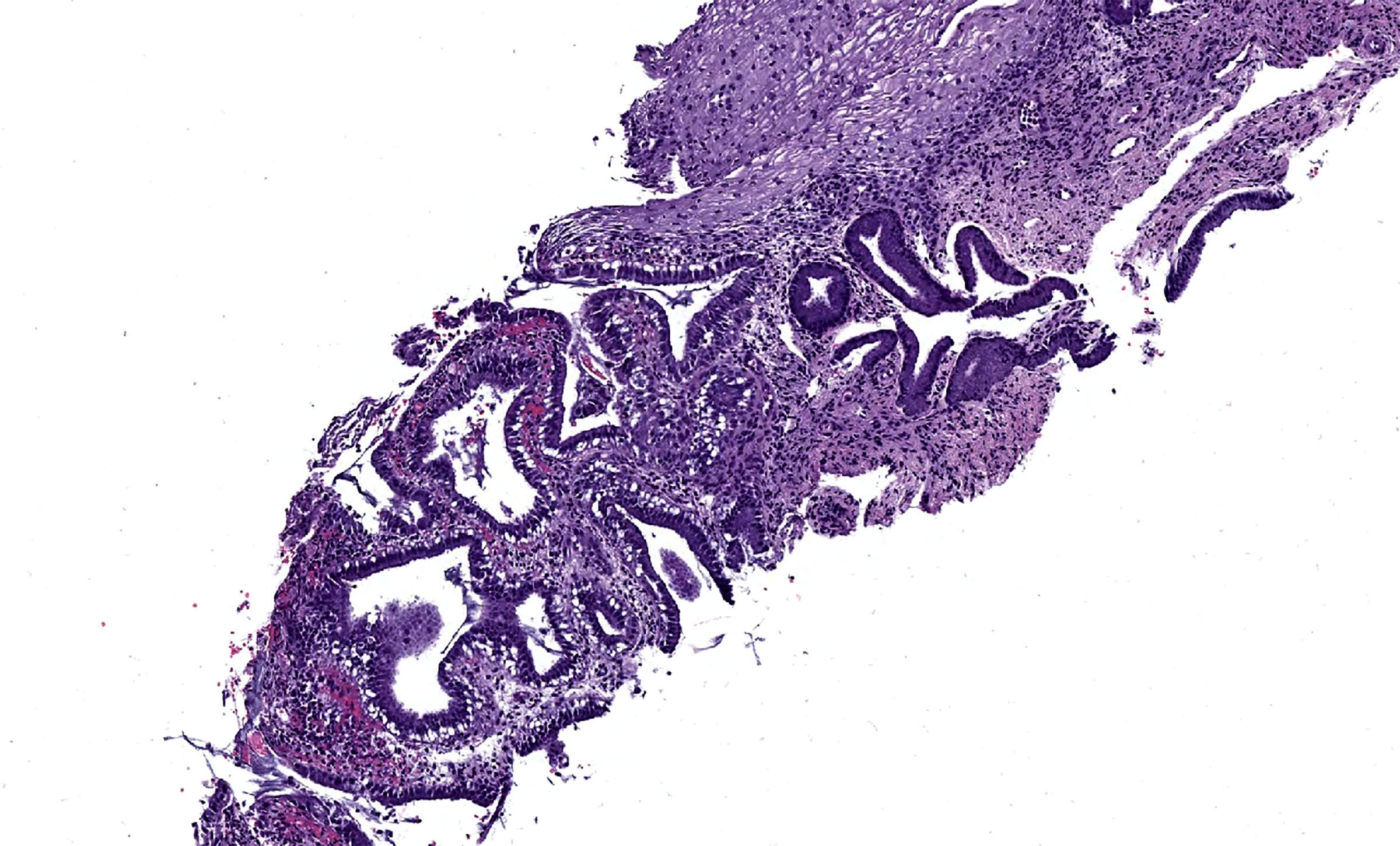 Pathology Outlines - Primary endometrioid adenocarcinoma (HPV independent)