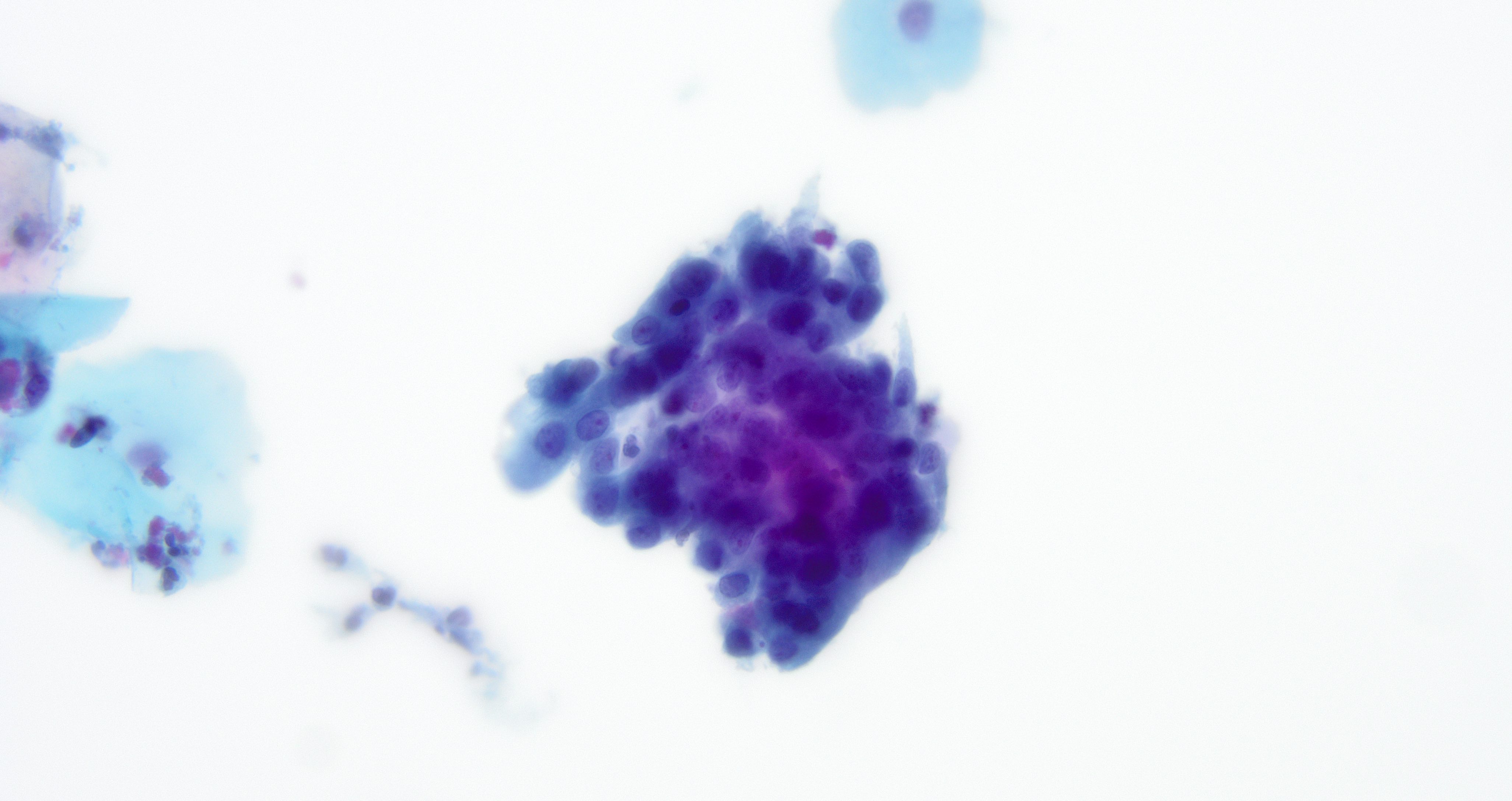 Pathology Outlines - SMILE (stratified mucin producing intraepithelial ...