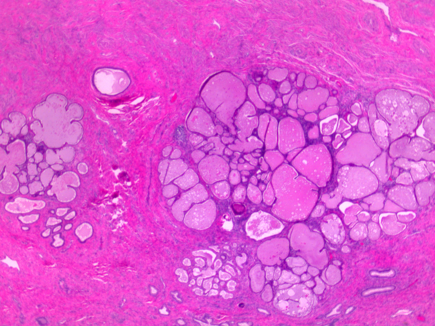 Pathology Outlines Tunnel Clusters