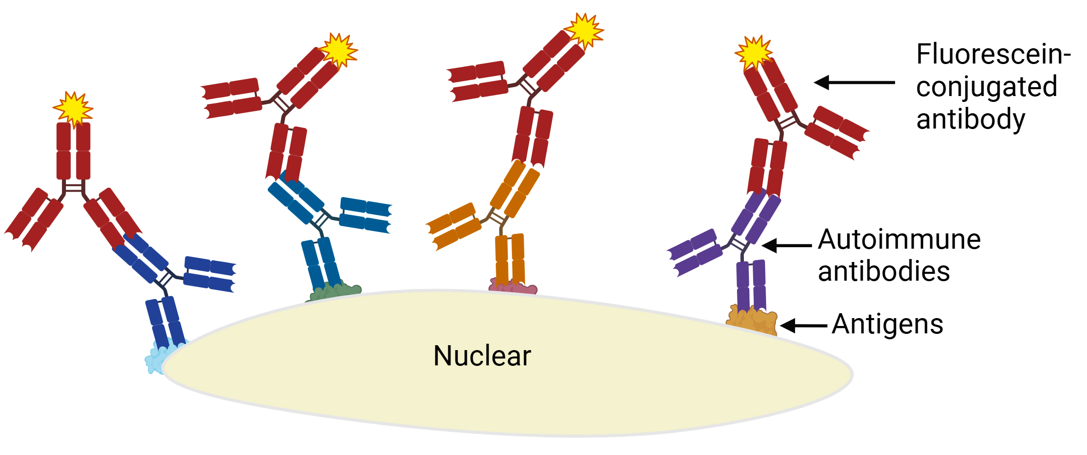 Pathology Outlines - Systemic lupus erythematosus (SLE)