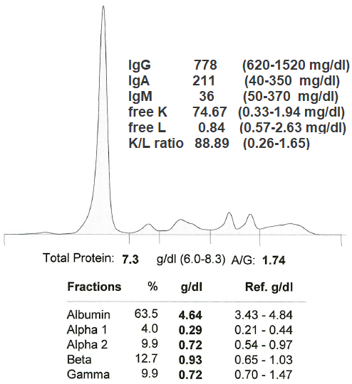 Pathology Outlines - Serum free light chain test