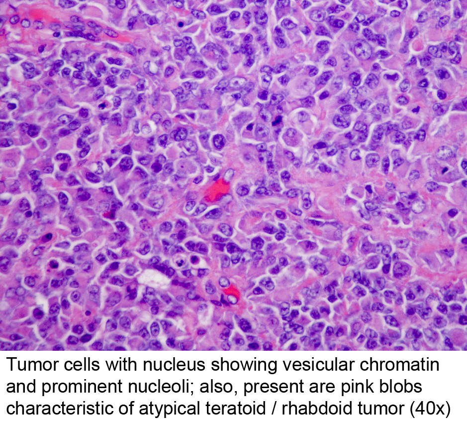 Pathology Outlines - Atypical teratoid / rhabdoid tumor