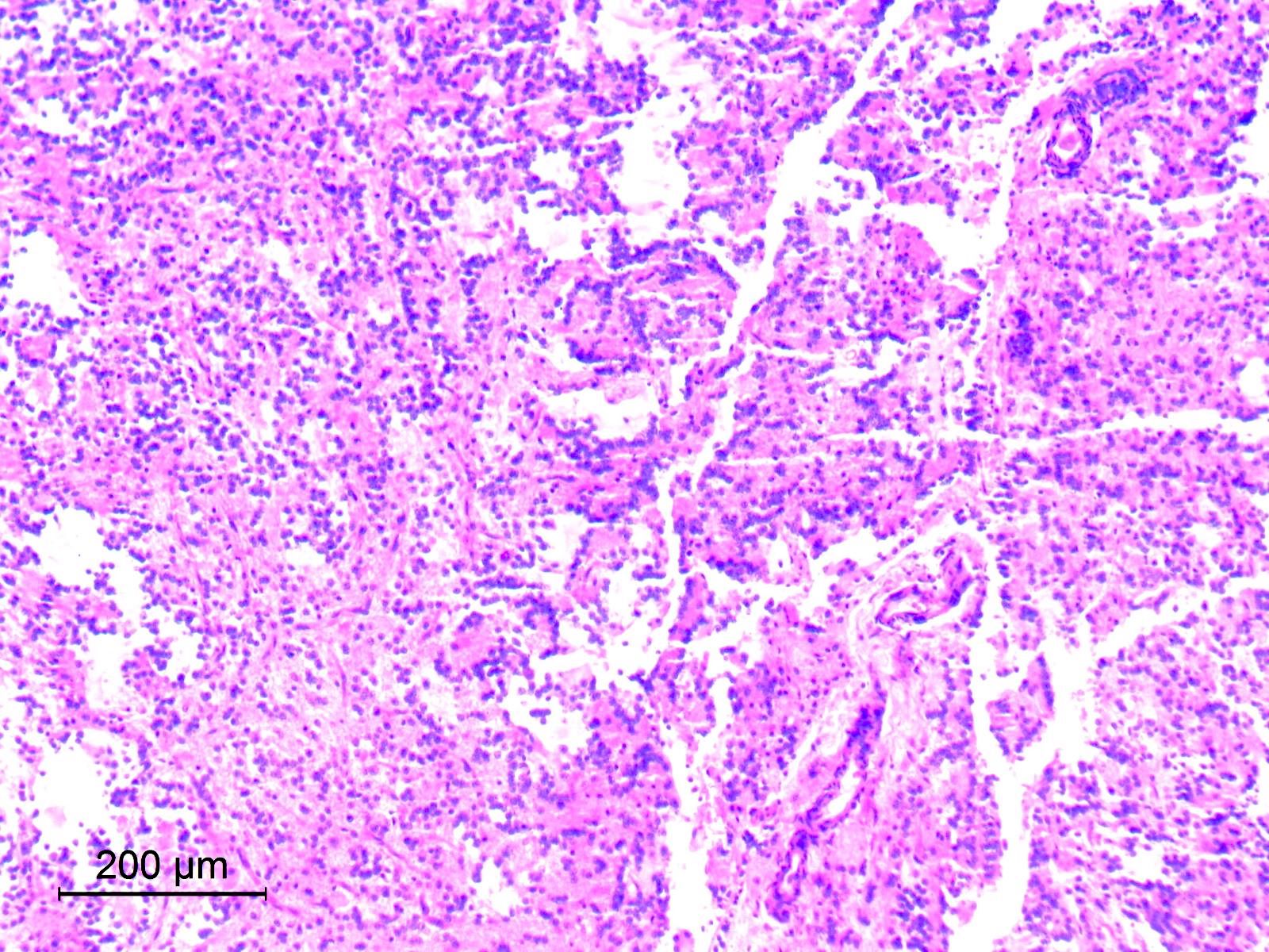 Pathology Outlines - Rosette forming glioneuronal tumor (RGNT)