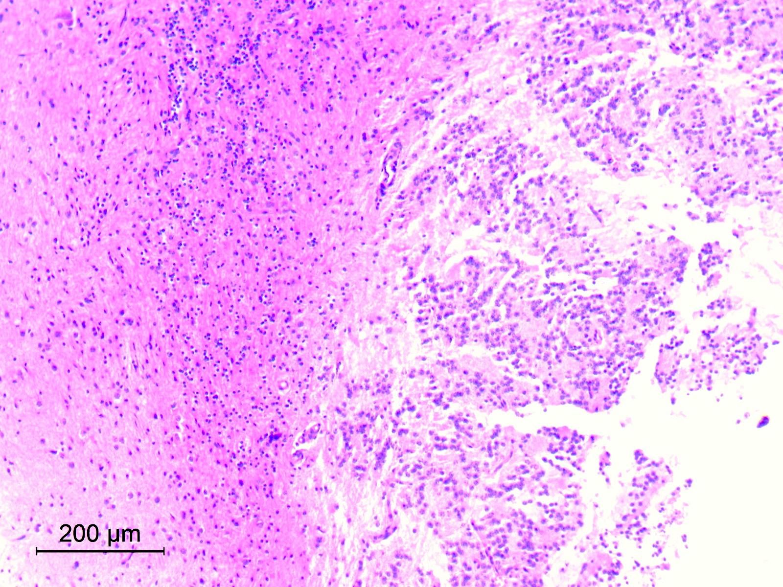 Pathology Outlines - Rosette forming glioneuronal tumor (RGNT)