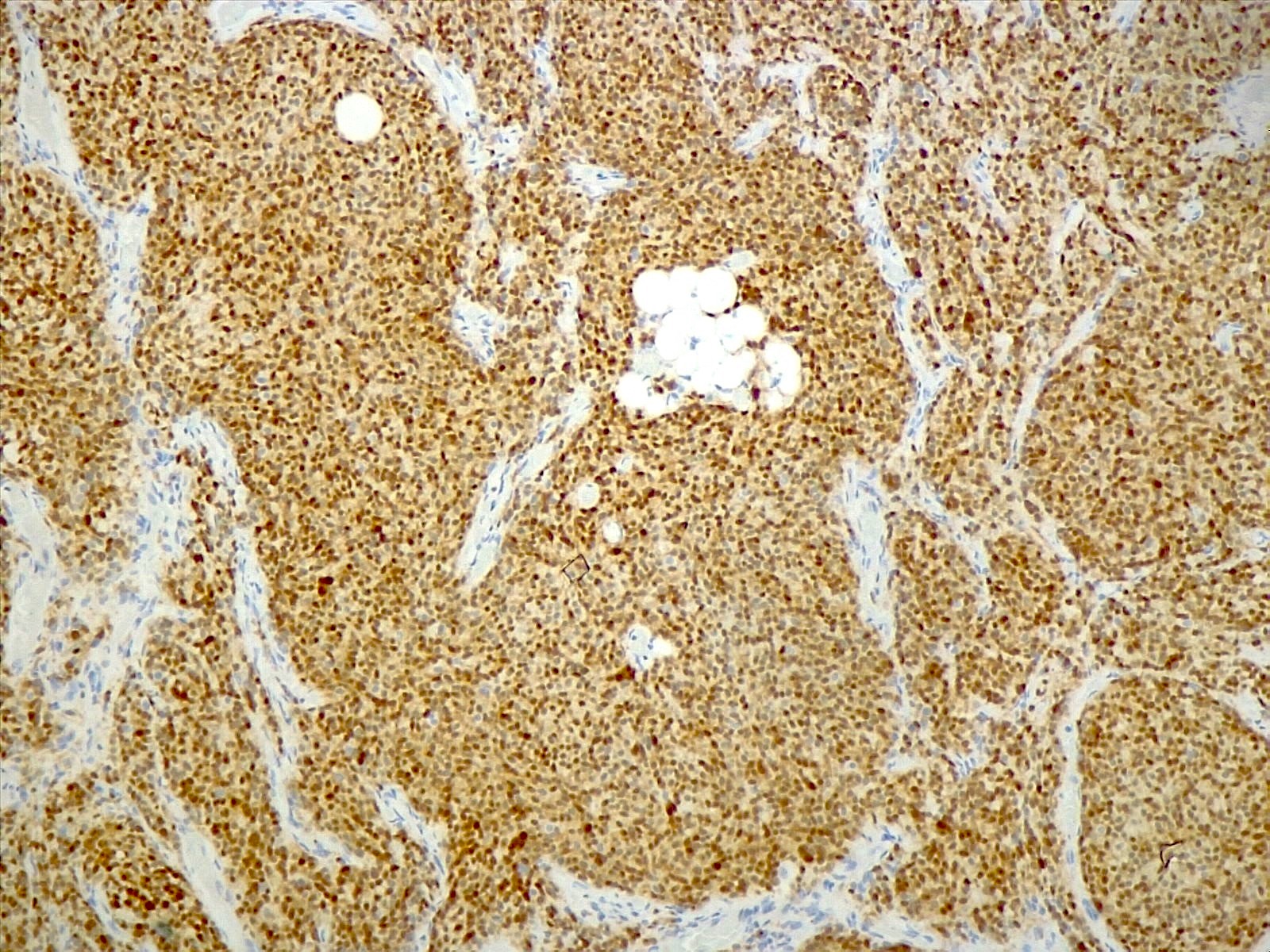 Pathology Outlines - Cerebellar liponeurocytoma