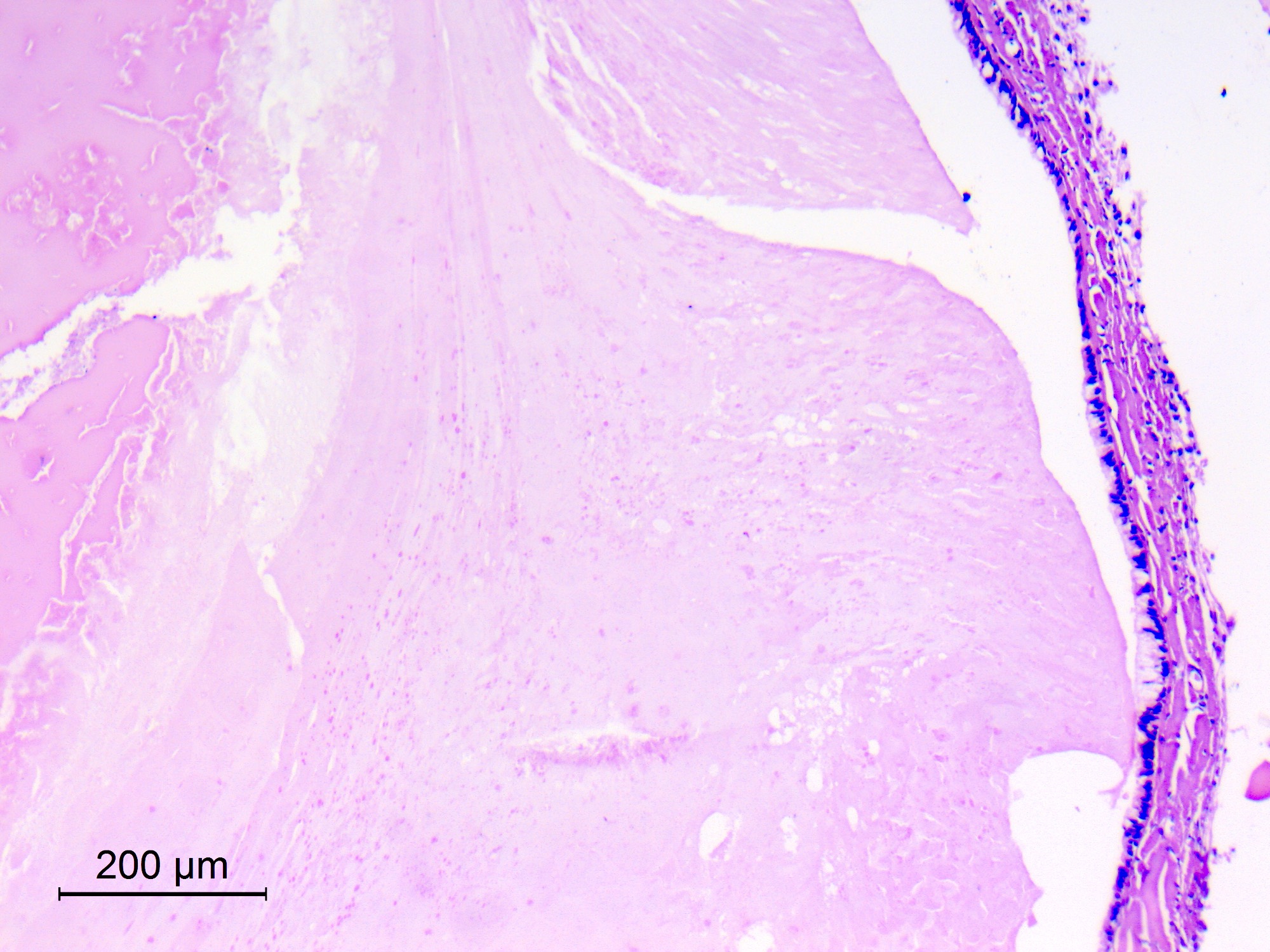 Pathology Outlines Epidermoid Cyst Pathology Outlines