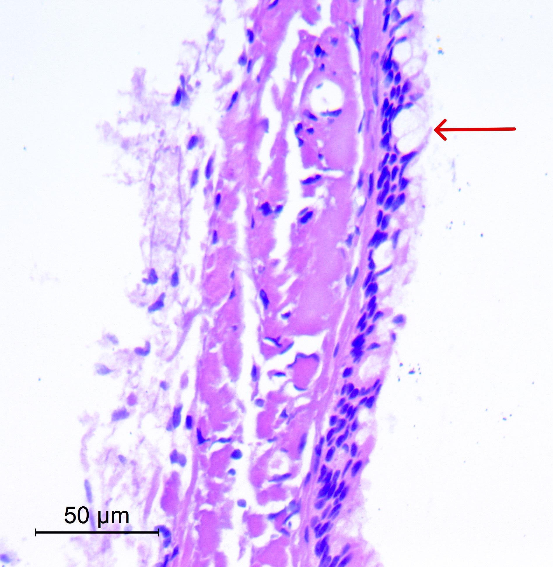 Pathology Outlines - Colloid cyst