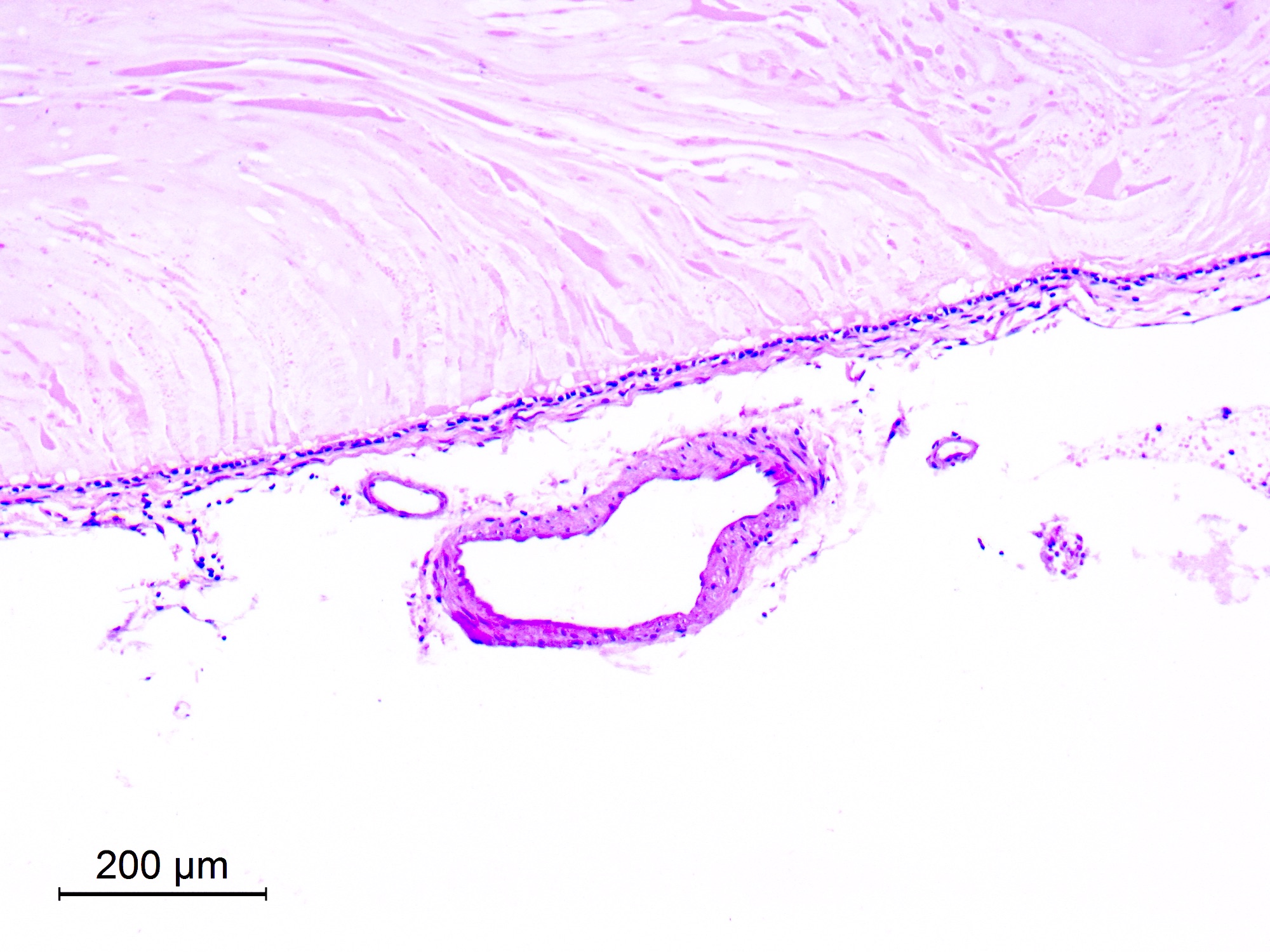 Pathology Outlines - Colloid cyst