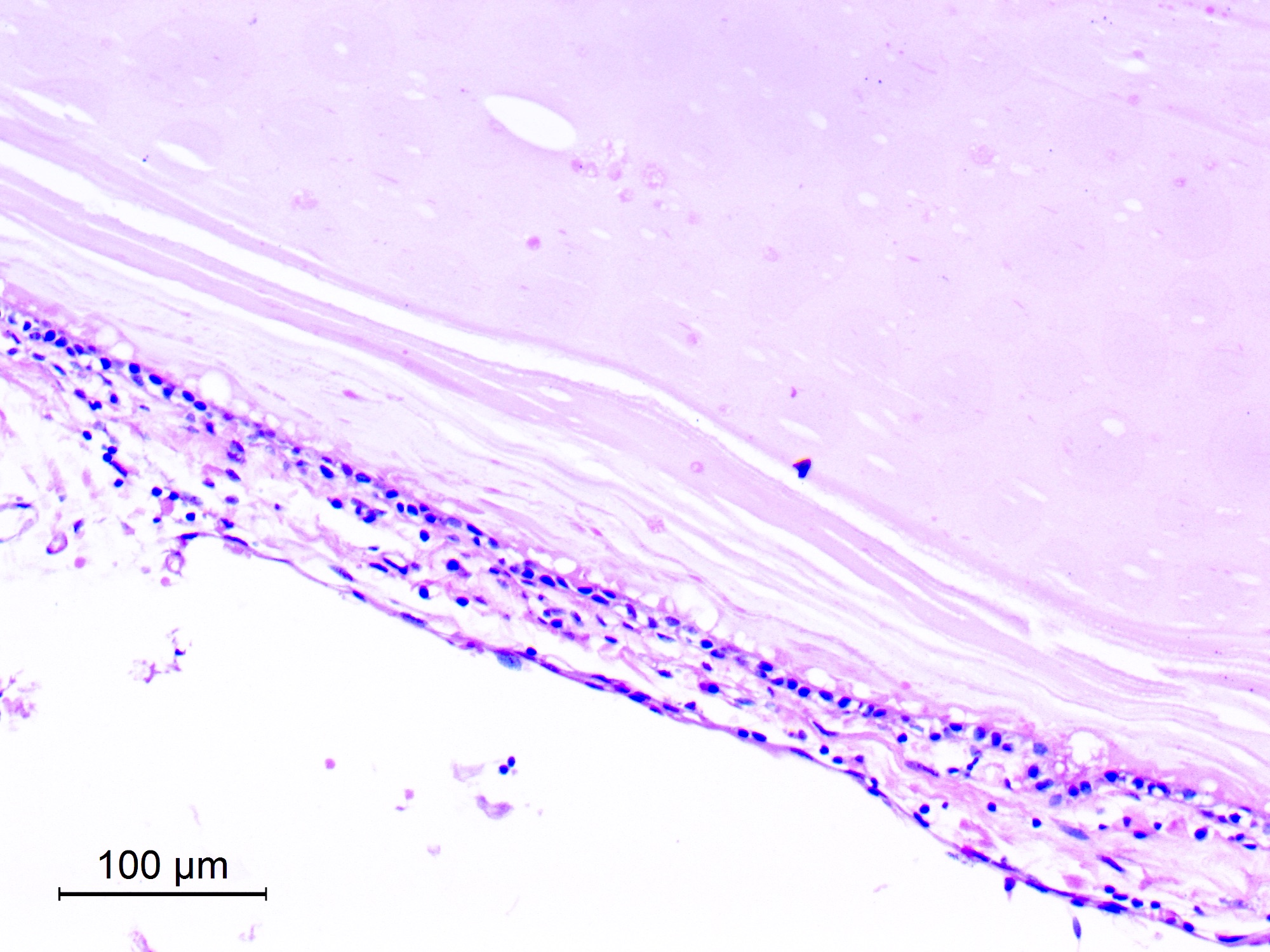 Pathology Outlines - Colloid cyst